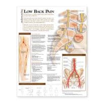 Understanding Low Back Pain Anatomical Chart | 9780781782432 | CDON